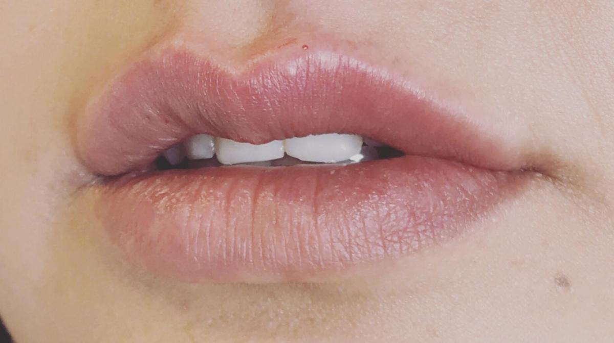Voor- en na foto's behandelingen - SKINiQ